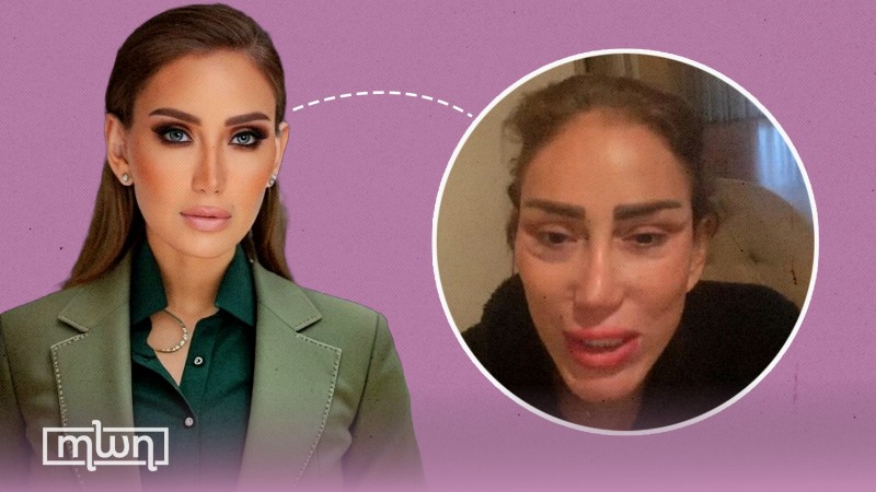 Reham Saeed Accuses Renowned Cosmetic Specialist of Botching Her Cosmetic Surgery