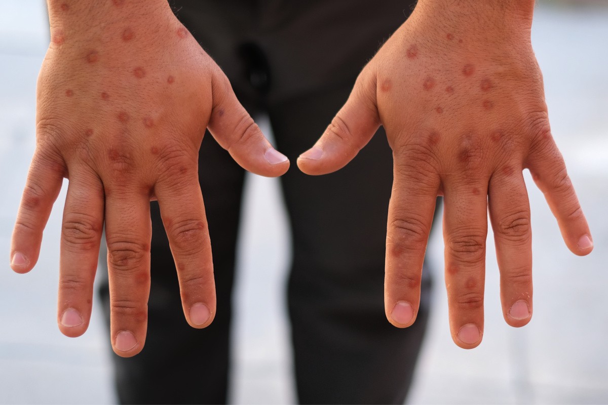 France Reports First Case of Dangerous Mpox Clade 1b Variant